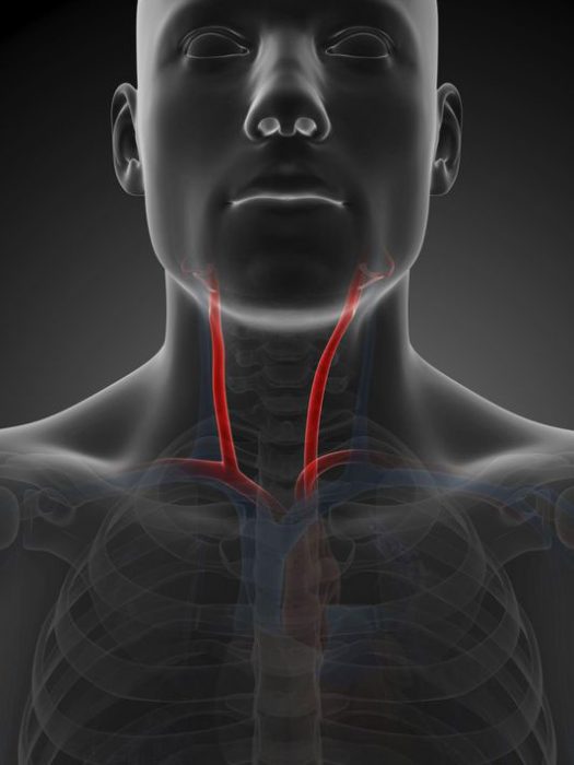 Obstrução Carotídea - Dr. Marco Munia