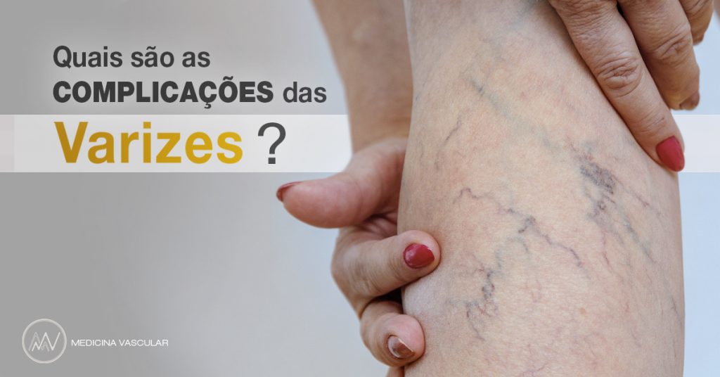 Quais são as complicações das Varizes? - Dr. Marco Munia
